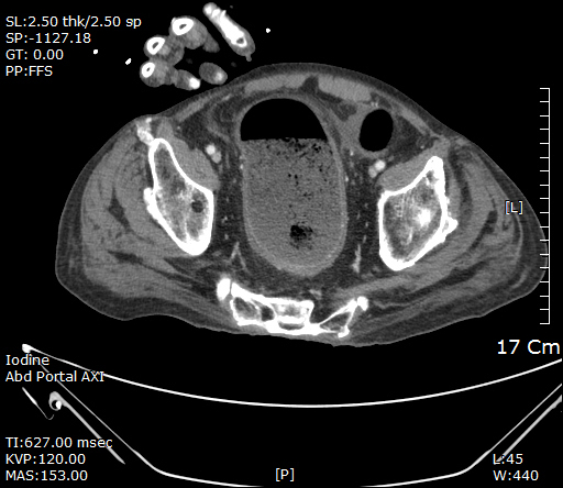 Stercoral colitis - 대변이 colon을 막으면 위험해! : 네이버 블로그