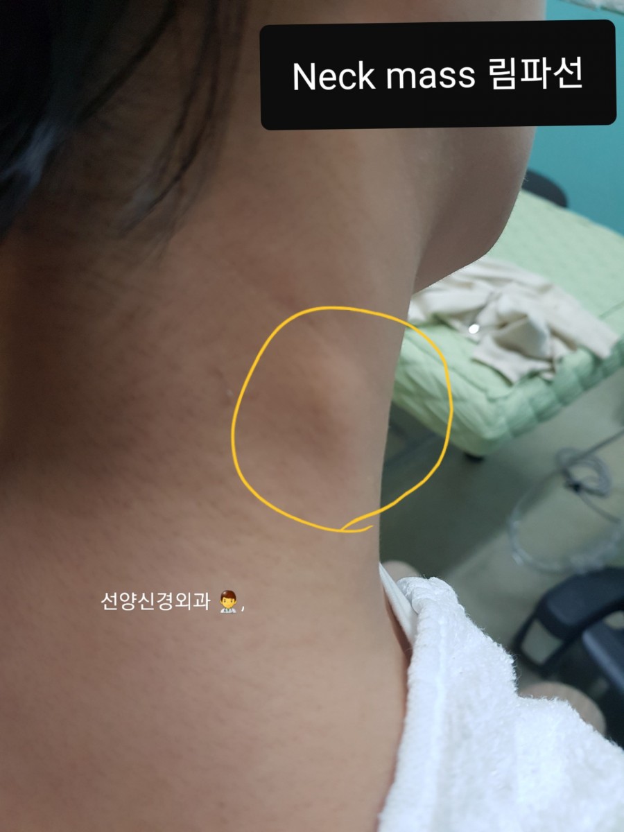 목에 멍울덩어리목혹이 만져저요 목 임파선 부종 임파선염 선양신경외과 네이버 블로그