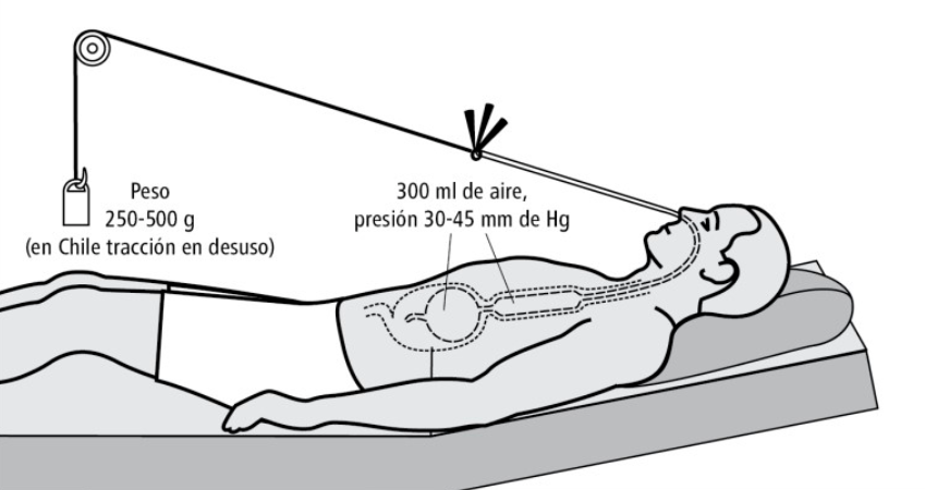 SB-tube (Sengstaken-Blakemore tube) : 네이버 블로그