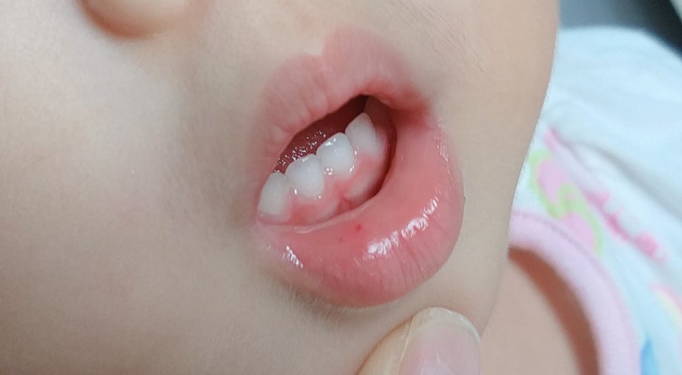 유아구내염 빨리낫는법 아기 어린이 구내염약 연고 페리톡겔 알보칠 네이버 블로그