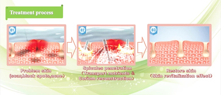 EC-spicule / 하이드롤라이즈드해면 Hydrolyzed Sponge / 스피큘(하이드롤라이즈드해면) 고순도 특허원료 ...