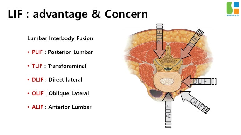 청담 우리들병원-척추유합술의 종류와 특징 장단점을 정리하였습니다 / 허리디스크 척추질환 수술치료 척추체간융합술 "ALIF ...
