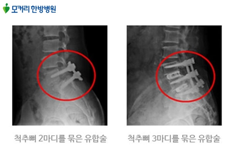 척추고정술나사못고정술에 대해 꼭 알아야 할 4가지 네이버 블로그