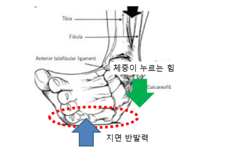 제 5 중족골의 원위부 골절 비수술적 치료 기브스 없이 걸었다가 좀 어긋나도 잘 붙을 수 있나요 5 중족골의 비 수술적