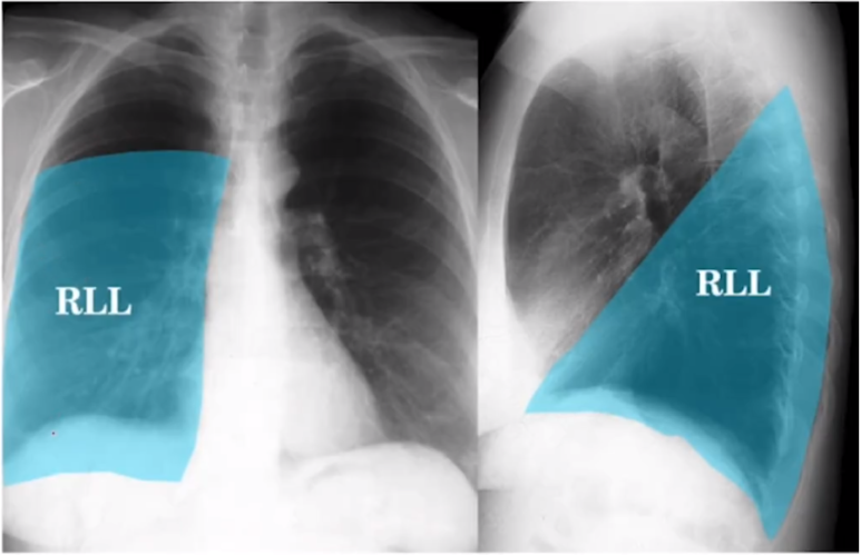 정상 흉부 X선 사진 (X-ray) 해부학 구조, 기본 판독 방법 : 네이버 블로그