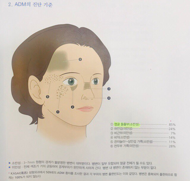 후천성 양측성 오타모반양 반점 (acquired bilateral nevus of Ota-like macules, ABNOM ...