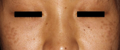 후천성 양측성 오타모반양 반점 (acquired bilateral nevus of Ota-like macules, ABNOM ...