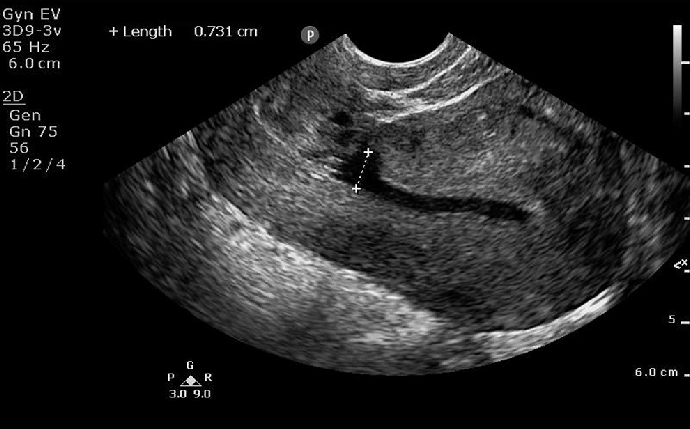 자궁의 제왕절개 흉터 결함 ; 자궁내시경적 치료 Hysteroscopic repair of cesarean scar ...