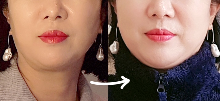 [리얼조이] 50대엄마 매선침 얼굴리프팅 이중턱리프팅후기 : 네이버 블로그