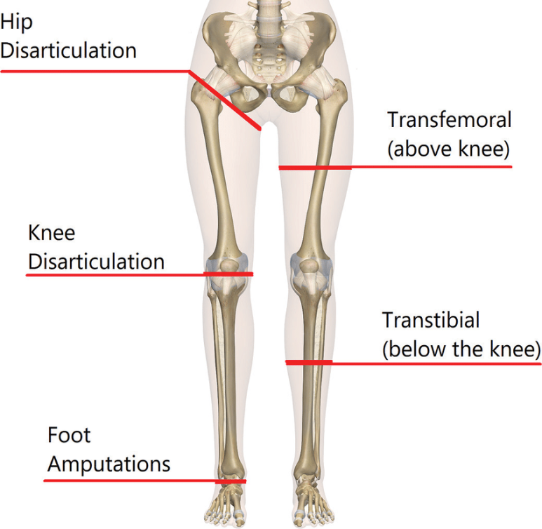 하지절단 운동법(대퇴절단,Above kee amputation) : 네이버 블로그