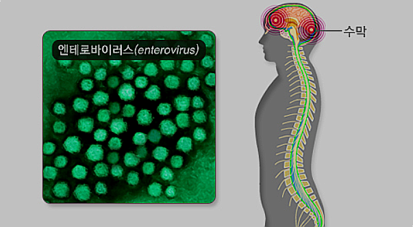 엔테로바이러스 감염증 원인 증상 치료 예방법 네이버 블로그