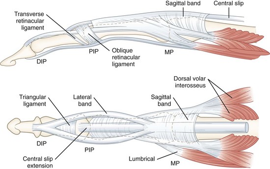 시상대 파열 ( Sagittal Band Rupture ) : 네이버 블로그