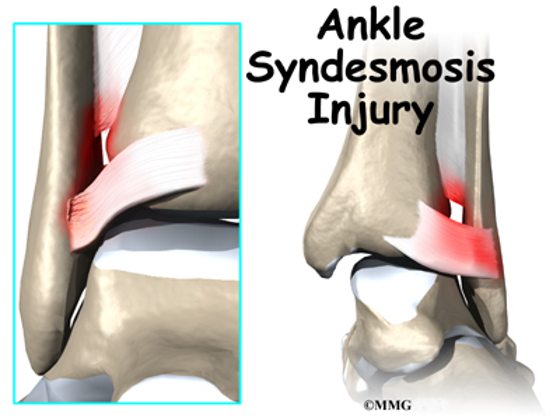 Ankle MBO(Modified Brostrom Operation) - 발목 인대 봉합술 : 네이버 블로그