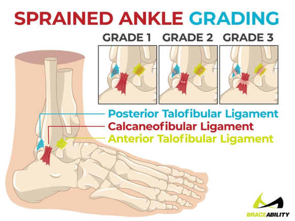 Ankle MBO(Modified Brostrom Operation) - 발목 인대 봉합술 : 네이버 블로그