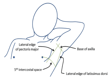 흉관 삽입술(Chest tube insertion, Thoracostomy, 기흉, 혈흉, Pneumothorax ...