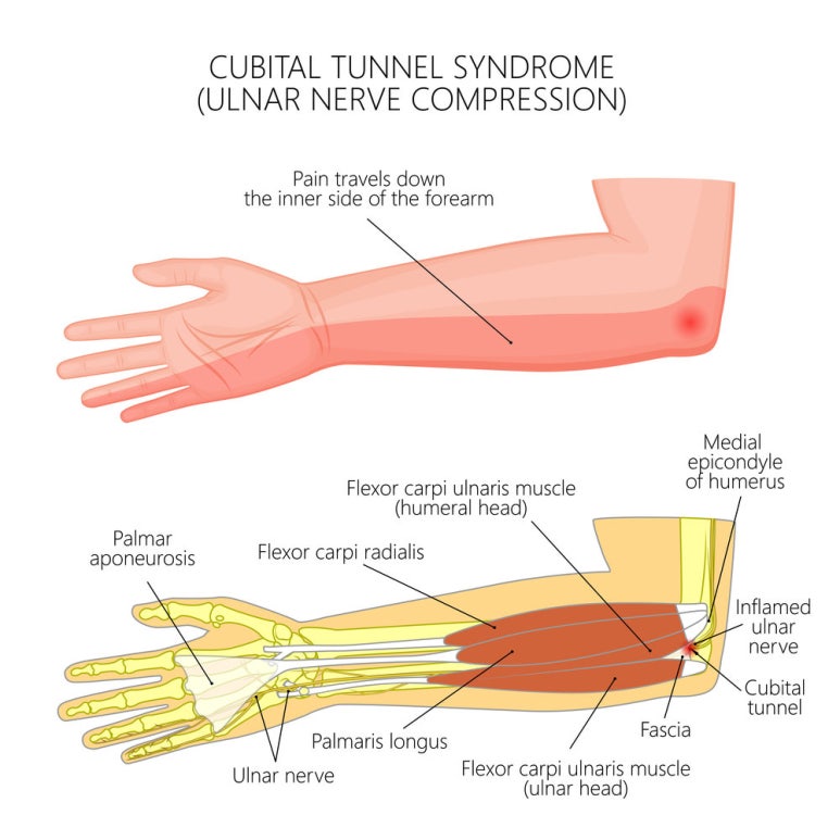 새끼손가락 저림, 주관 증후군(Cubital tunnel syndrome), 지연성 척골신경마비(tardy ulnar nerve ...