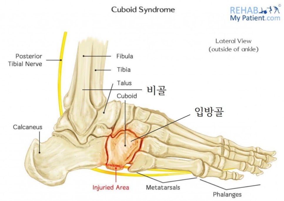 무릎 바깥쪽 통증 세가지 원인 알려드립니다 네이버 블로그