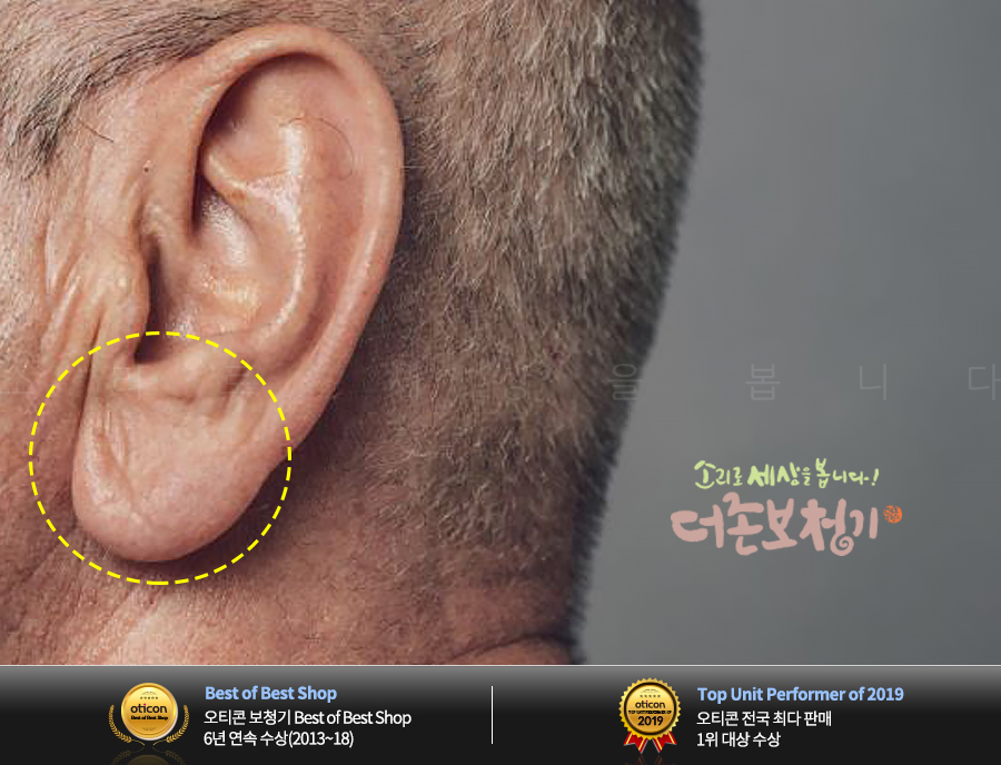귓볼 대각선 주름 치매 및 대구 난청과의 연관성 네이버 블로그