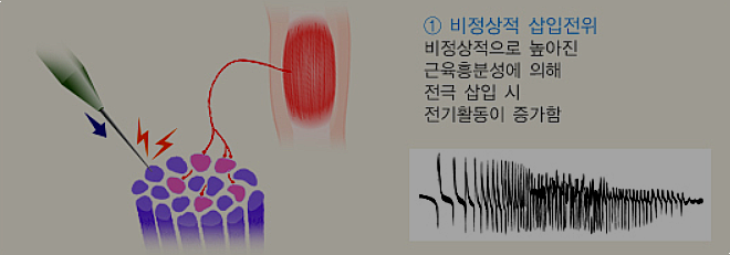근전도검사 신경전도검사 검사의 적용 네이버 블로그