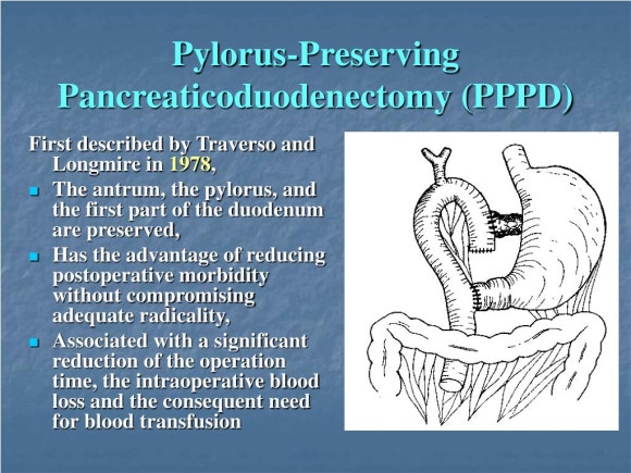 유문부 보존 췌두부십이지장 절제술(Pylorus preserving pancreaticoduodenectomy,PPPD ...