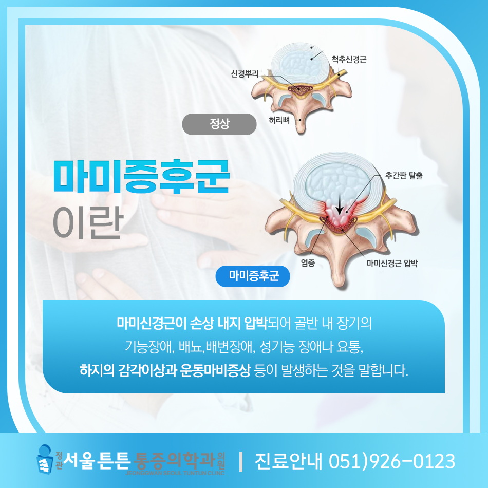 기장척추통증 마미증후군 심화단계와 치료법 네이버 블로그