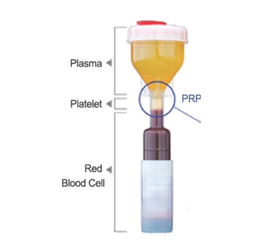 (중요) PRP(혈소판풍부혈장) (platelet-rich plasma)