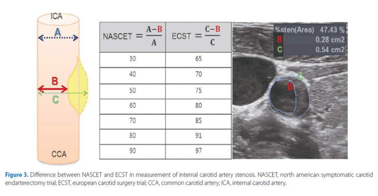 경동맥 초음파 - 죽상경화반(플라크)과 경동맥 협착 + 치료 : 네이버 블로그