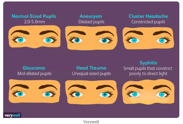 신경계 사정 :: 의식수준(LOC, GCS, PGCS) 사정, 동공크기(pupil size), 동공반사(광반사, light ...
