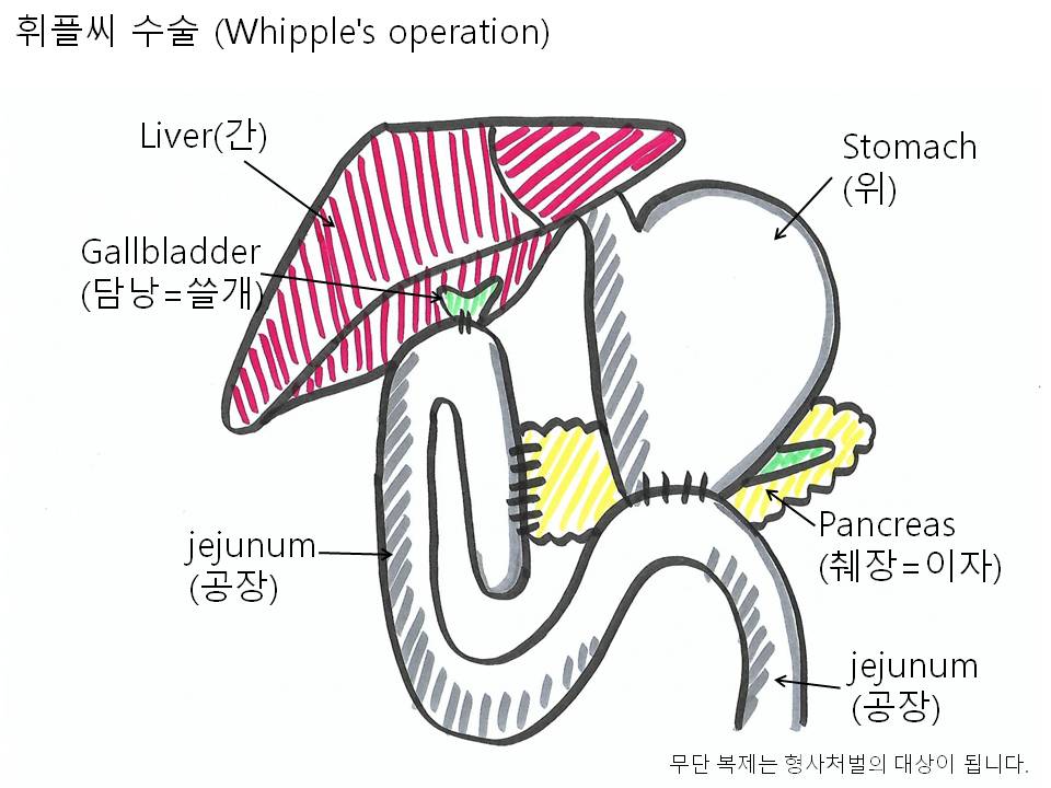 [췌장암 5탄] 췌장암 수술 '유문보존 췌십이지장 절제술( Pylorus-preserving ...