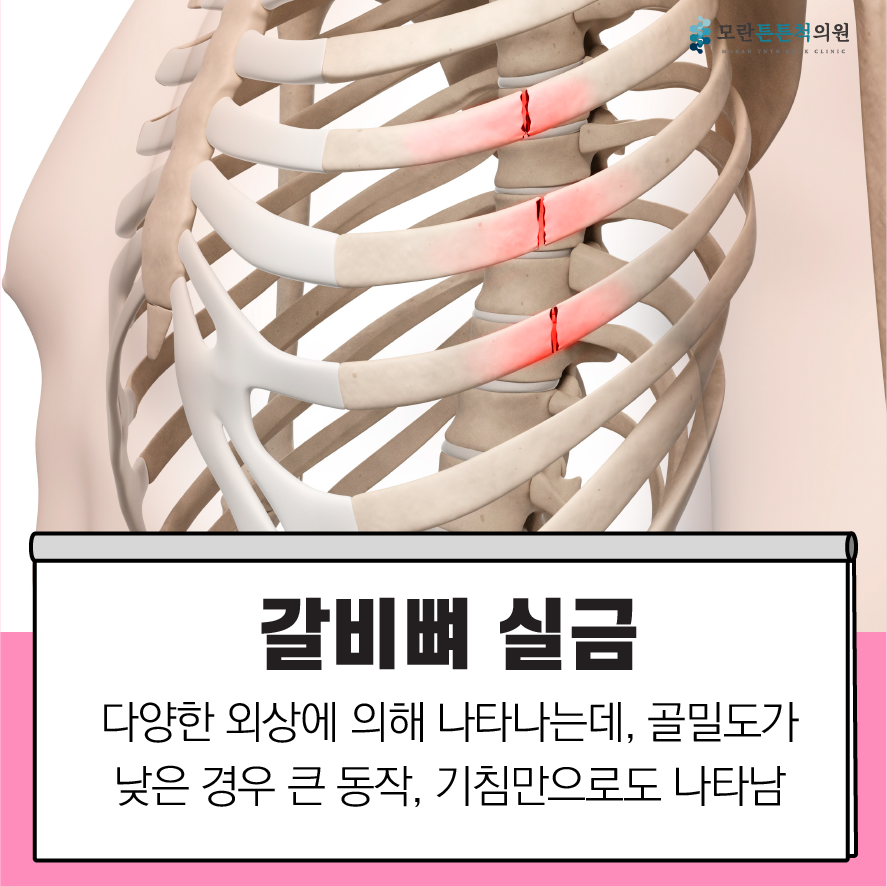 기침 갈비뼈 통증 재채기할때 갈비뼈실금 증상 네이버 블로그