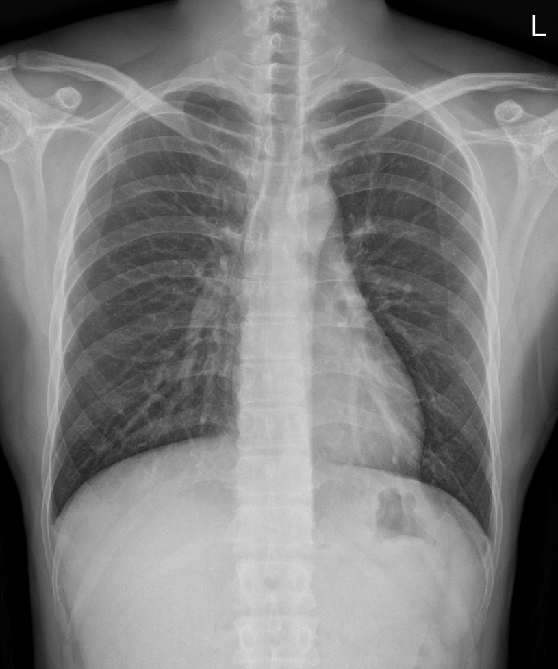 Chest x-ray(Chest PA, AP, Lateral, decubitus) : 네이버 블로그
