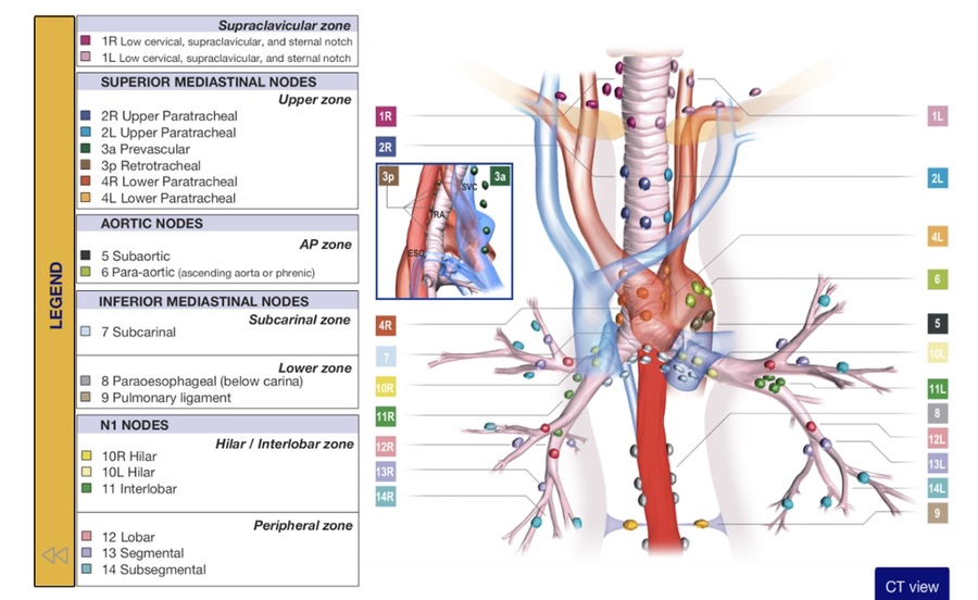 [호흡기내과] EBUS(초음파 기관지 내시경), EBUS-TBNA, Radial EBUS(EBUS-GS) TBLB 차이점 ...