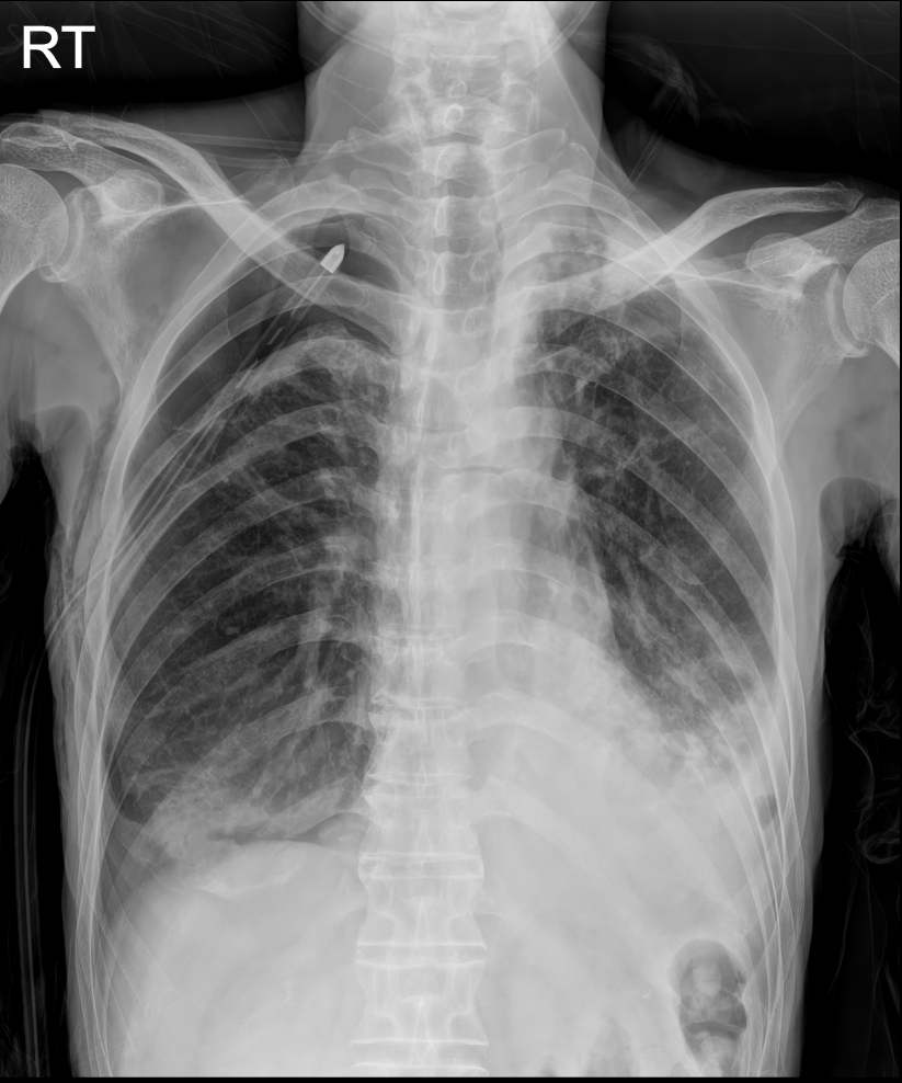 Pneumothorax(기흉), CTD bottle 종류 : 네이버 블로그