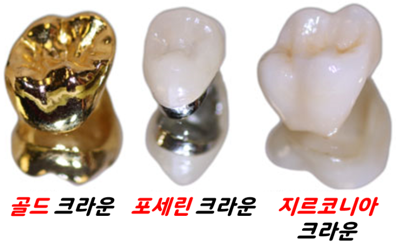 크라운종류와 치과재료의 특징 골드 포세린pfm 지르코니아의 장점과 단점 네이버 블로그