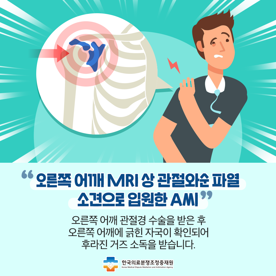 어깨 관절 수술 후 화상을 입었습니다 네이버 블로그