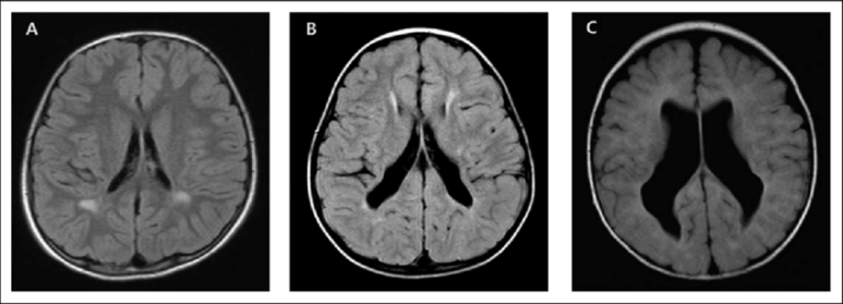 뇌실주위백질연화증(PVL; periventricular leukomalacia) : 네이버 블로그