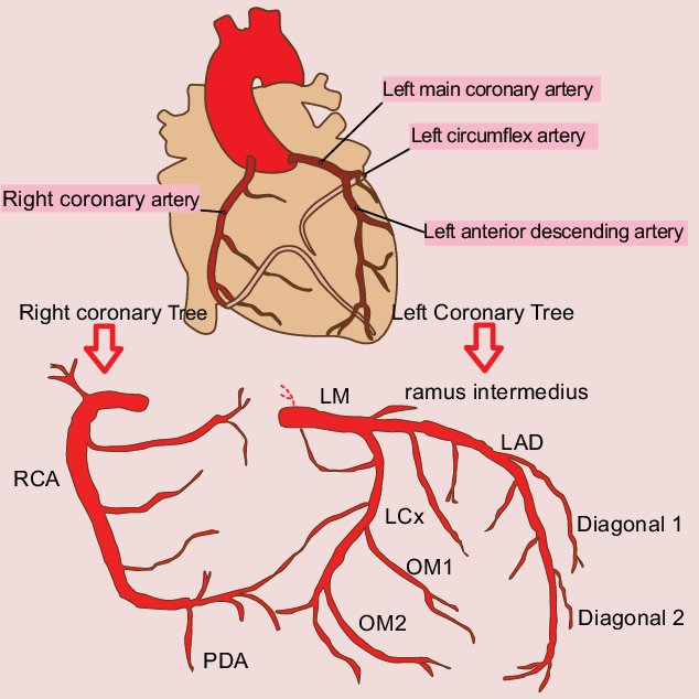 coronary artery stenosis (관상동맥 협착) : 네이버 블로그