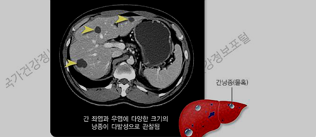 간 낭종 증상과 진단 검사 치료법 네이버 블로그