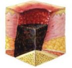 욕창 단계 - 4단계, 미분류 욕창 증상 설명, 치료법과 욕창 드레싱 : 네이버 블로그