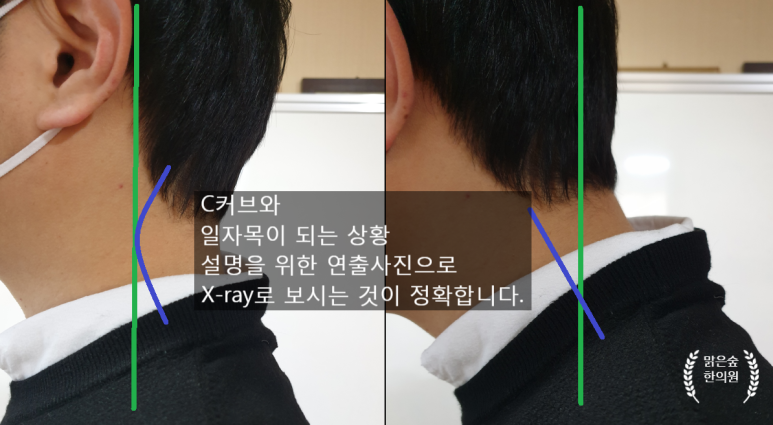 뒷머리 찌릿 뒷머리 통증 경추성 두통 근긴장성 두통 네이버 블로그