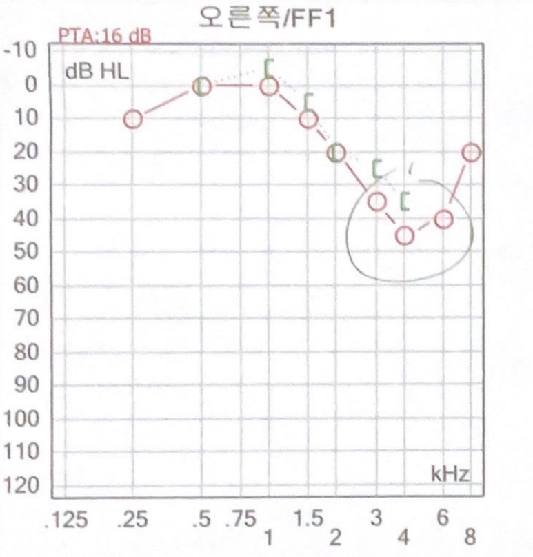 질환질병 소음성 난청noise Induced Hearing Loss 네이버 블로그