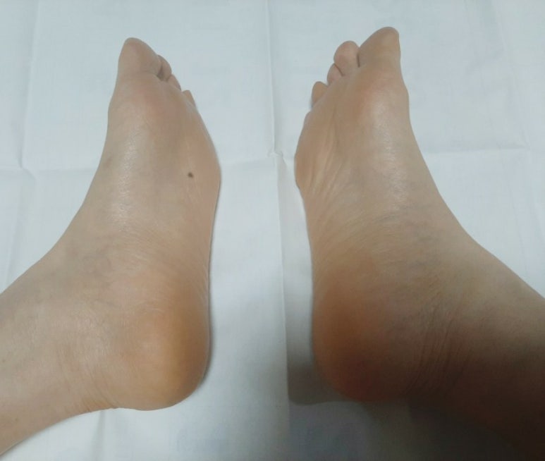 발 뒤꿈치 갈라짐 발바닥 각질제거 닥터씨 발각질제거기 3총사로 애기피부 만들어요 네이버 블로그