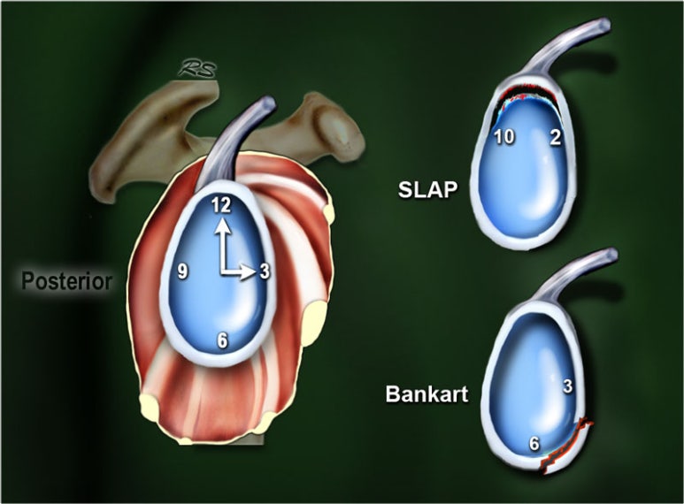 Shoulder A/S Bankart repair : 네이버 블로그