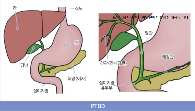 의학용어 PTBD 시술 전 후 간호부터 irrigation까지 : 네이버 블로그