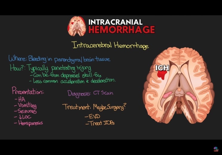 의학용어 ICH, SDH, SAH, IVH, EDH 증상, 치료, 원인 공부하기 : 네이버 블로그