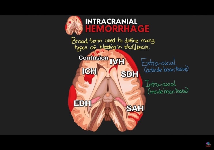 의학용어 ICH, SDH, SAH, IVH, EDH 증상, 치료, 원인 공부하기 : 네이버 블로그