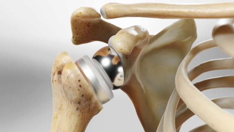 [OS수술] RTSA(Reverse Total Shoulder Arthroplasty, 역행성 어깨 인공관절 치환술) : 네이버 블로그