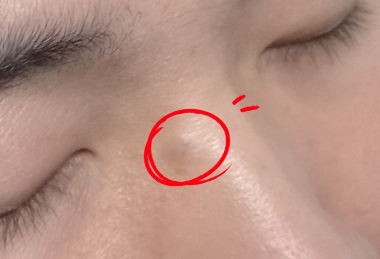 피지낭종 제거 수술 10일차 결과 실비청구 총 비용 및 보상 정보 토스 병원비돌려받기 네이버 블로그