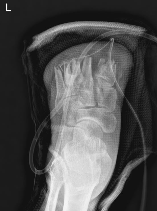 의학용어 TMA, TMT amputation 은? : 네이버 블로그