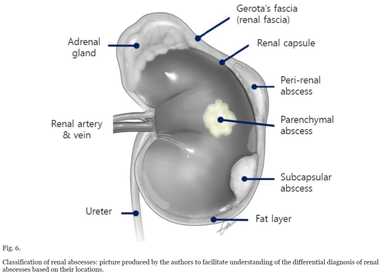 Renal abscess (신장 농양), Perinephric abscess (신장 주위 농양) : 네이버 블로그